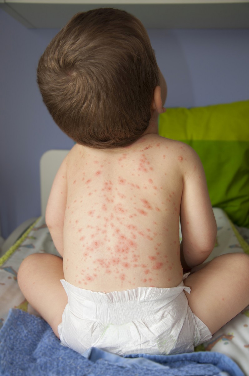 Chickenpox on the Rise: Expert Advice from Cook Children’s