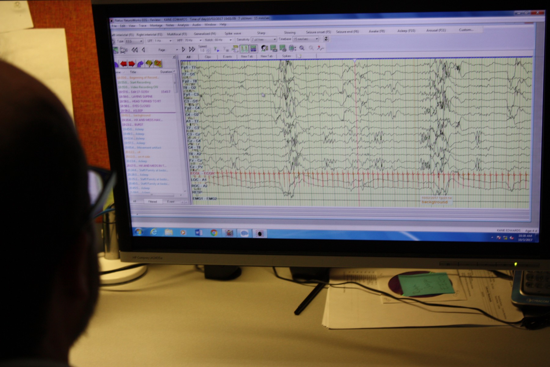 Could Component of Diet Pill 'Fen-Phen' Treat Epilepsy?