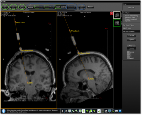 What is Deep Brain Stimulation Surgery?
