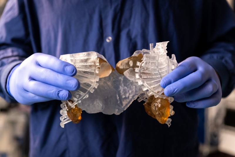 Conjoined Twin Girls Separated at Cook Children’s