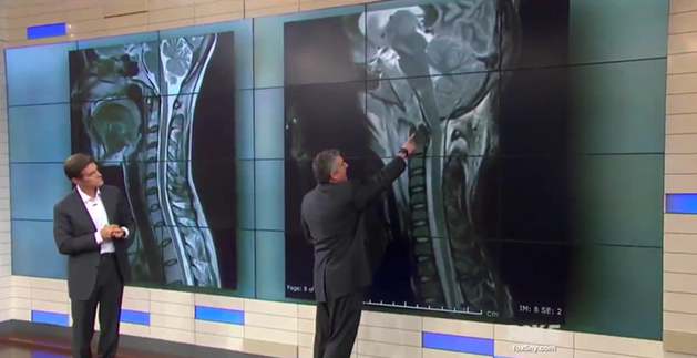 Cook Children's Neurosurgeon Talks Medical Phenomenon on National TV