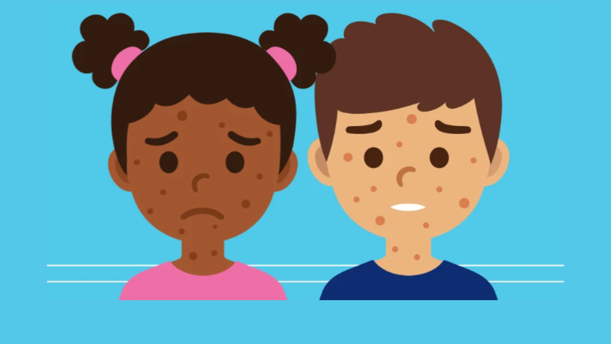 Keeping Your Kids Safe: Understanding the Measles Exposure at Grapevine ...