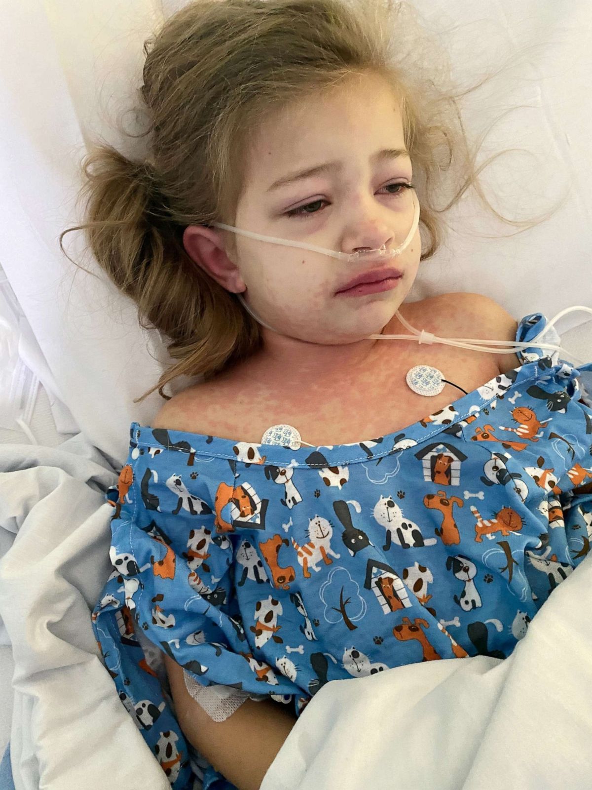 Know the Signs: Mother Shares 5-Year-Old's MIS-C Fight