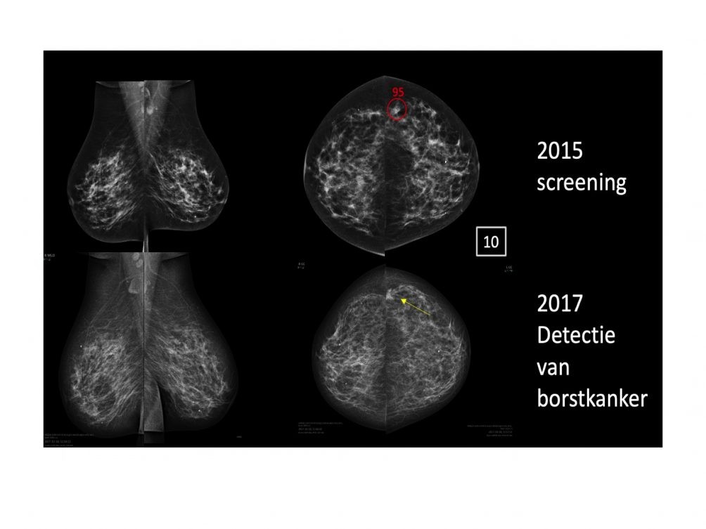 AI kan al beter borstkanker ontdekken dan de specialist