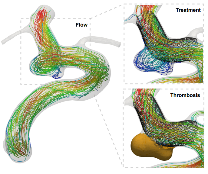 Research progress reveals faster, more accurate blood flow simulation ... Research progress reveals faster, more accurate blood flow simulation ...