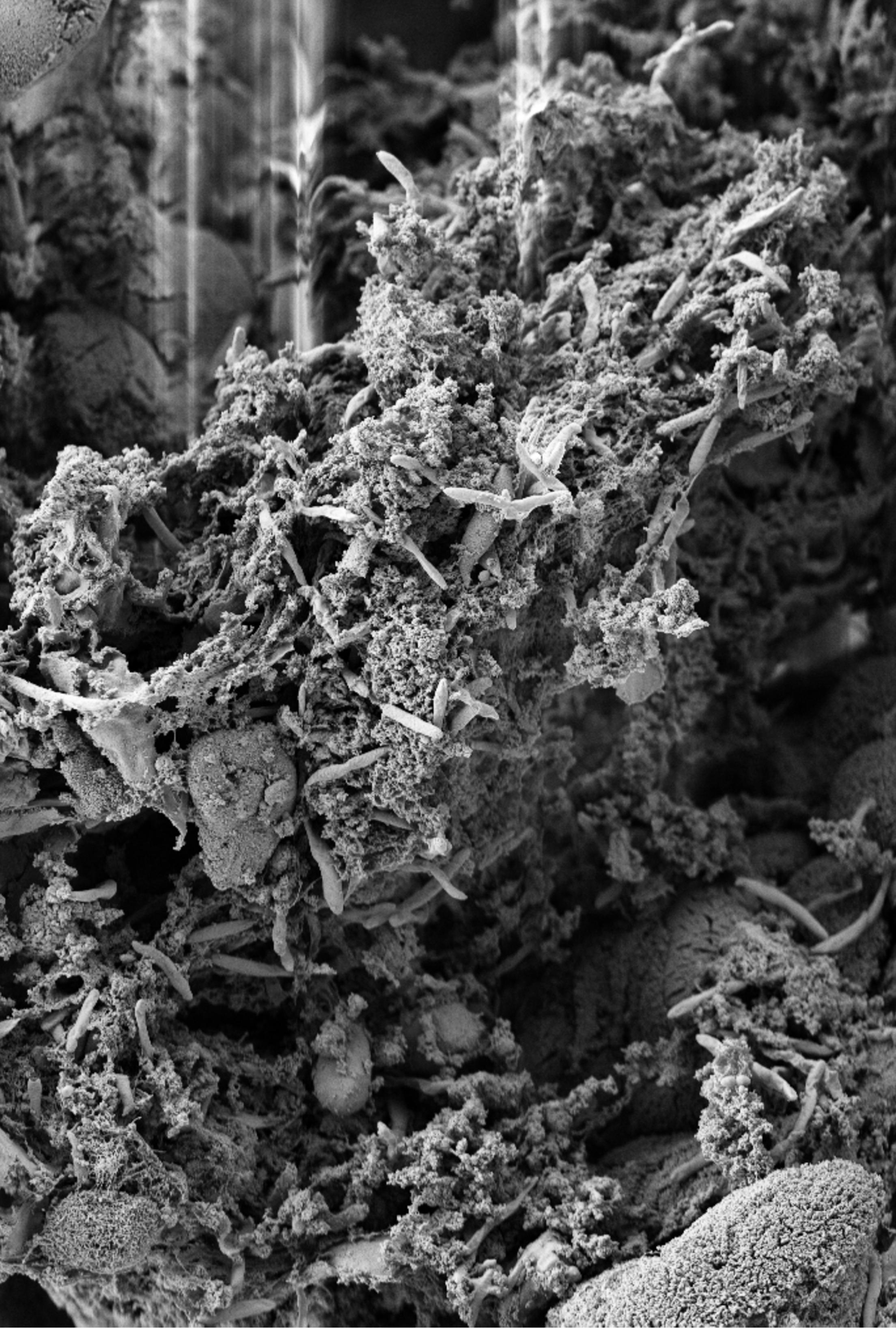 Antibiotics are ‘avoidable trigger’ for bowel disease