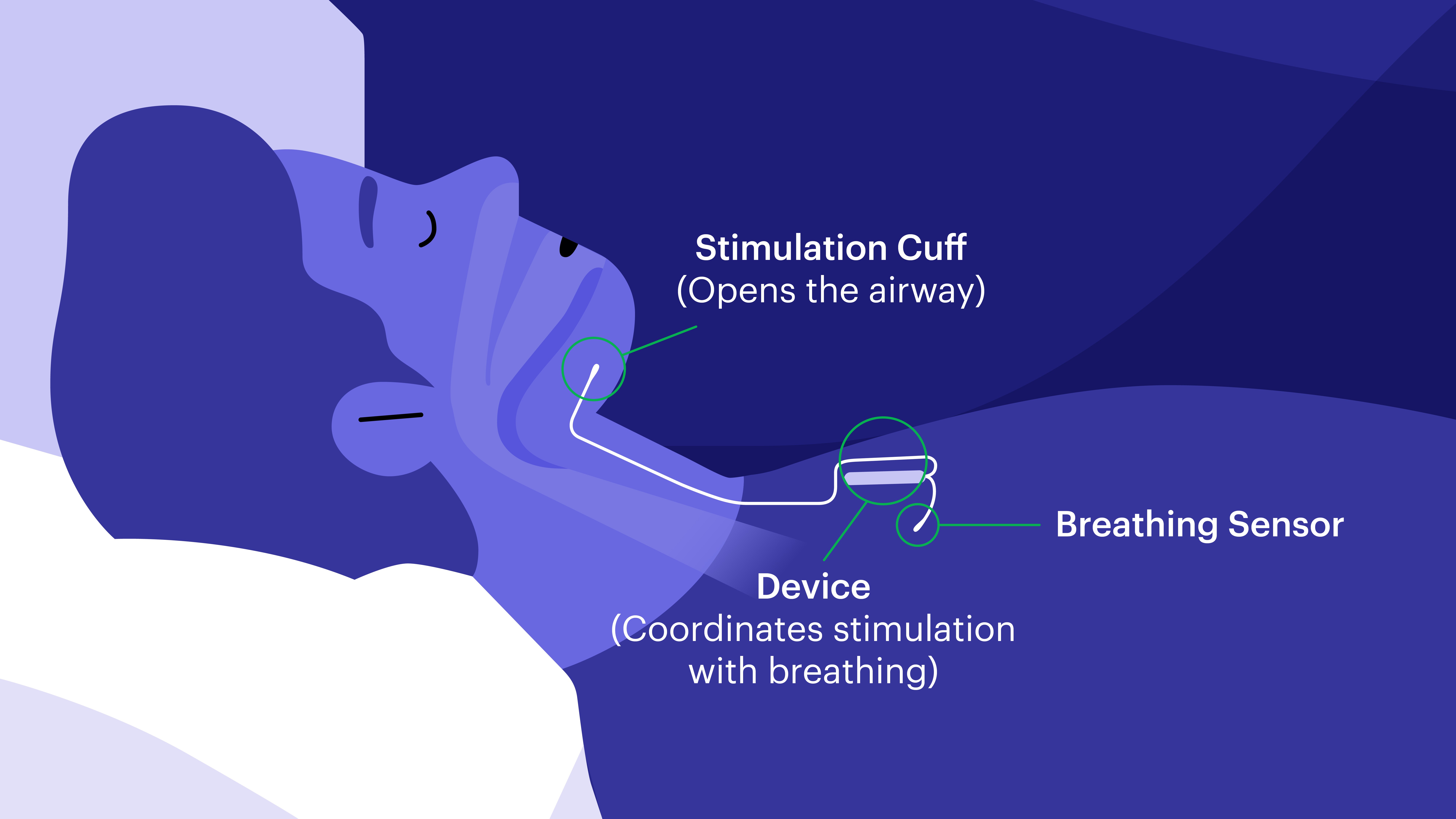 First Inspire Implant at OhioHealth Doctors Hospital To Help People ...