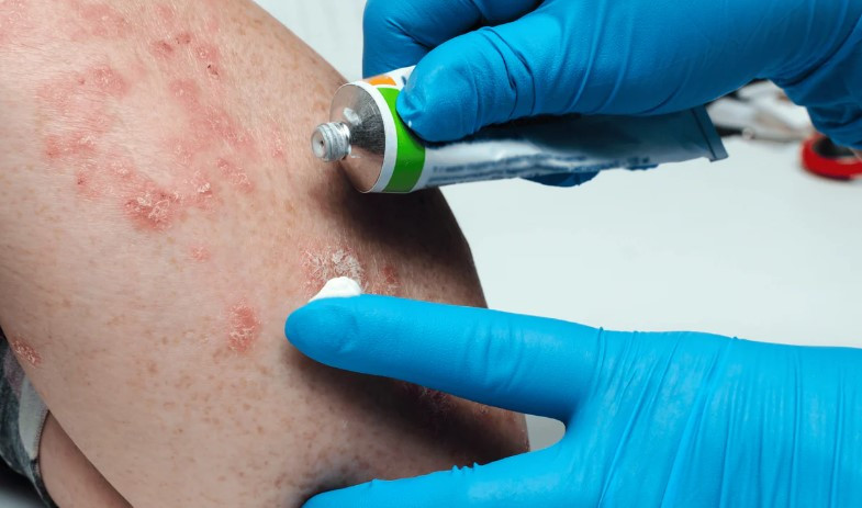 Medscape: Kids with Obesity at Higher Risk for Skin Conditions