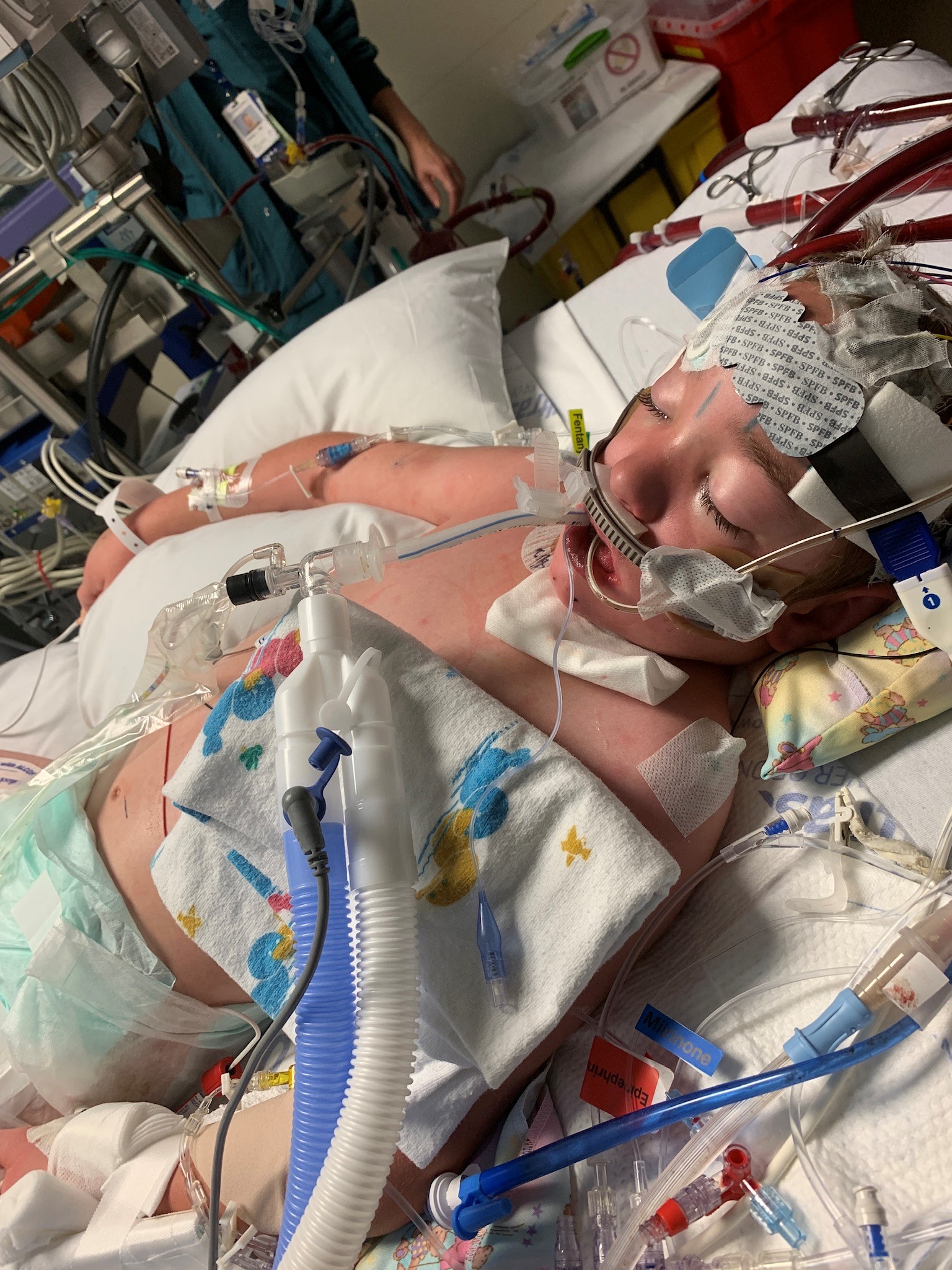 After reaching its 1,000th ECMO run, Children’s Mercy team reflects on ...