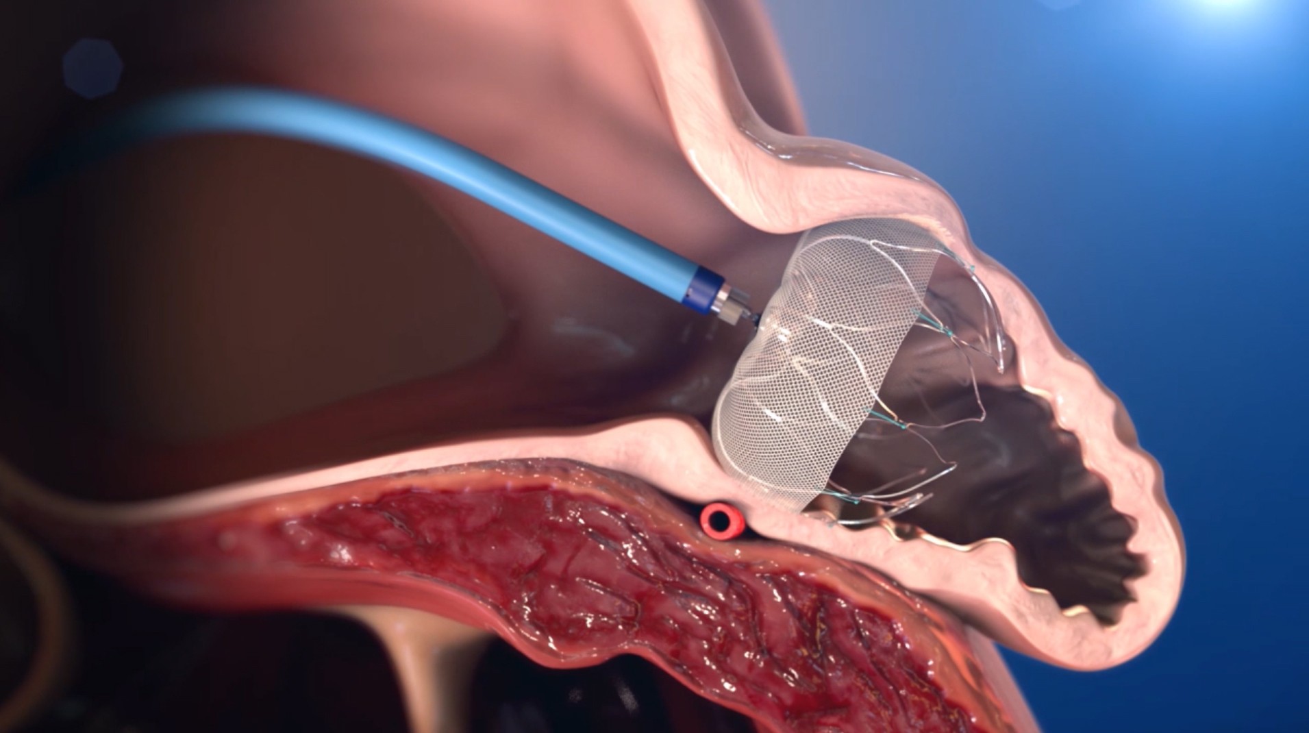 Watchman Procedure Reduces Stroke Risk In AFib Patients Watchman Procedure Reduces Stroke Risk In AFib Patients