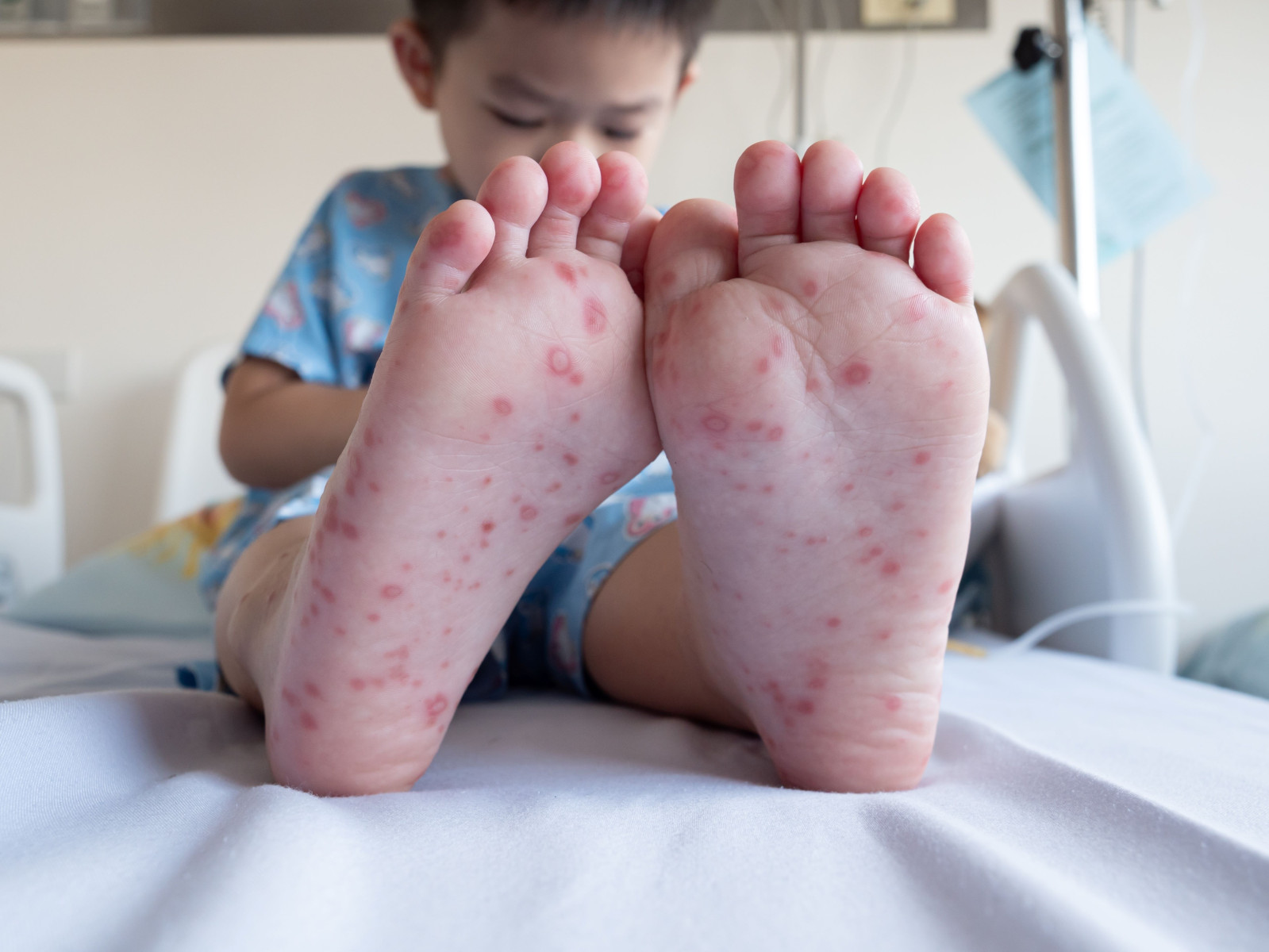 Hand Foot And Mouth Disease In A Baby