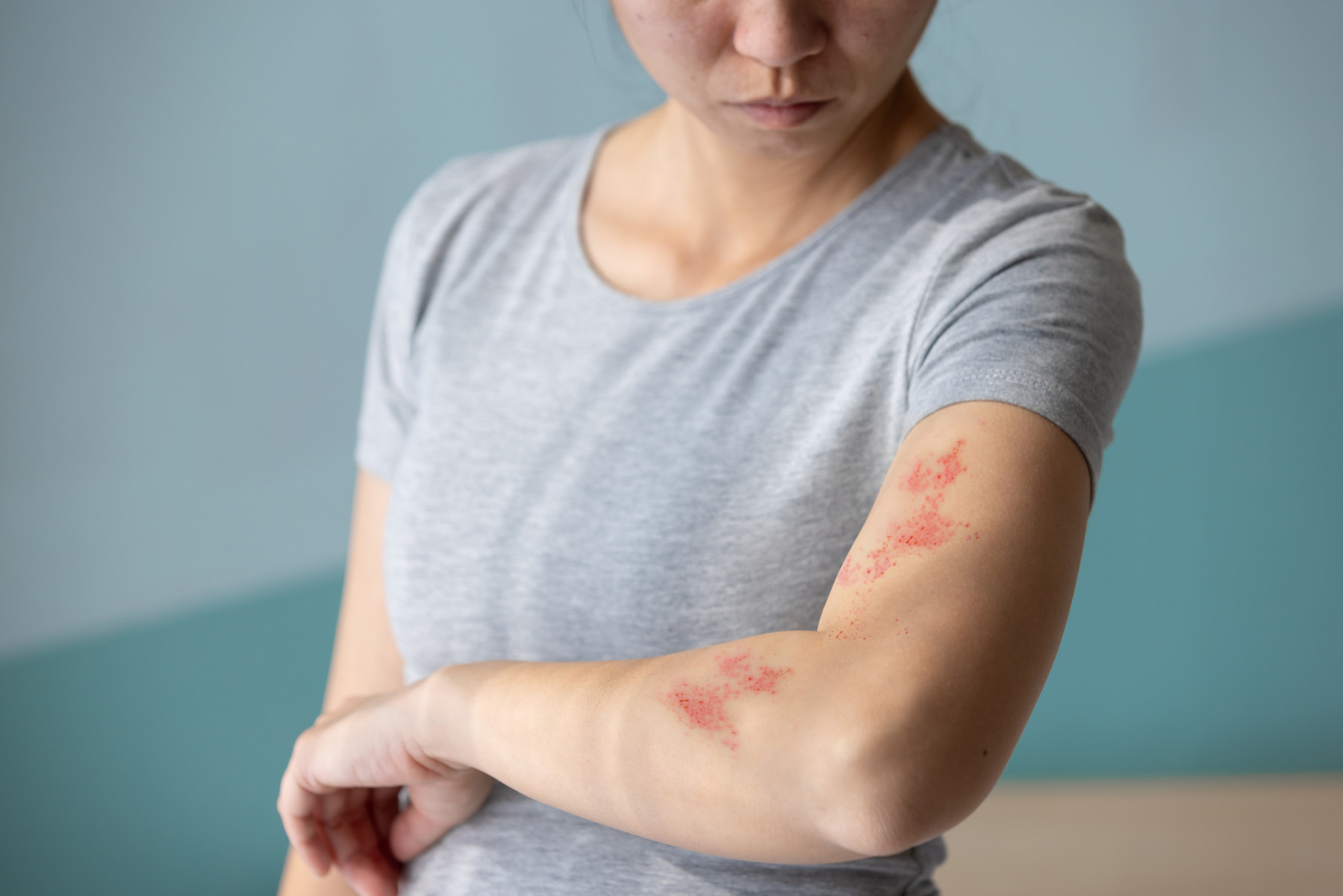 Shingles treatment continues to evolve