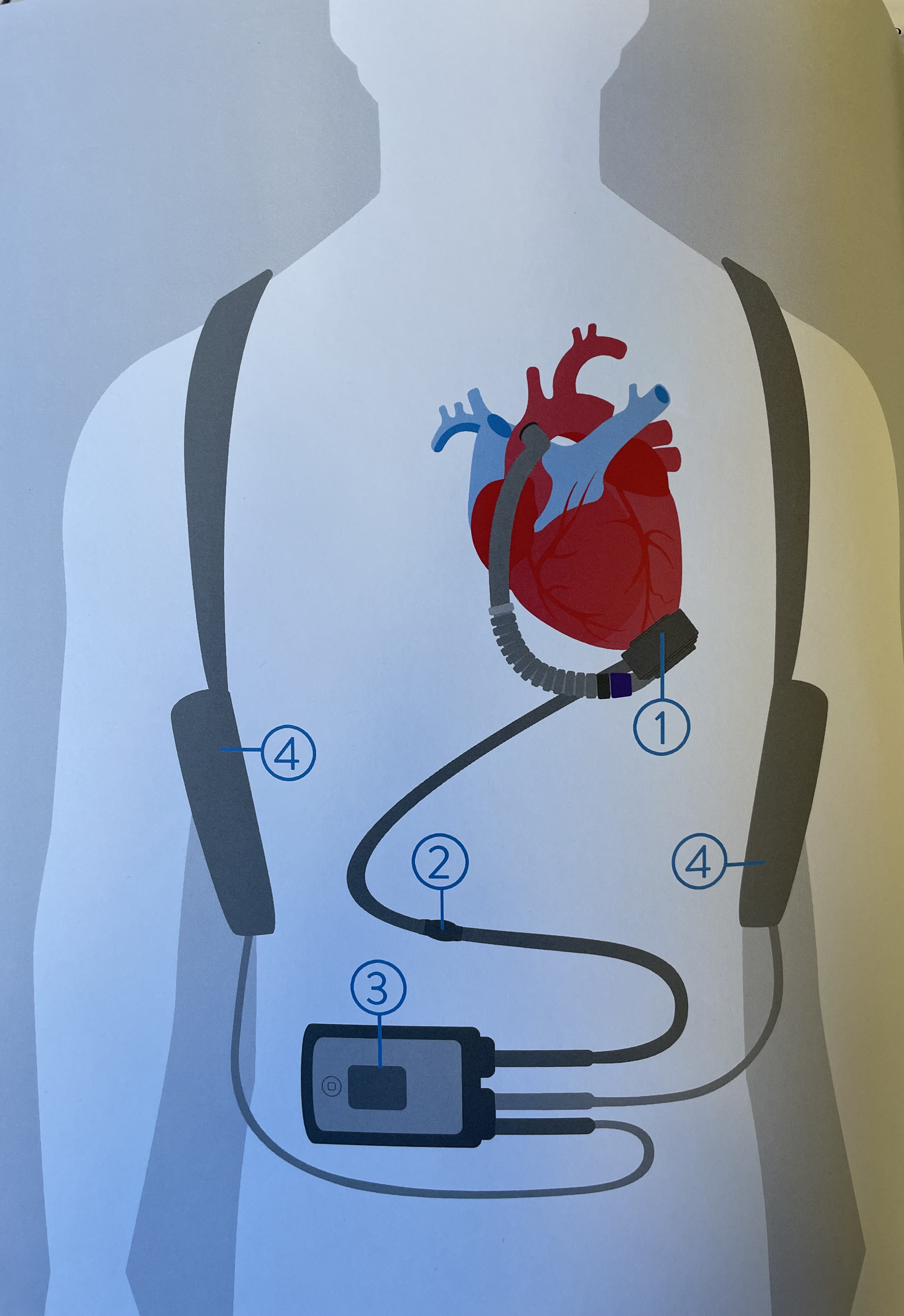 LVADs improve, extend life for heart failure patients | Vermilion ...