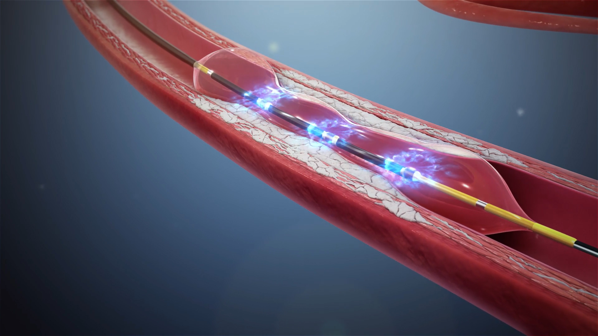 New Heart Tech Sends Shockwaves