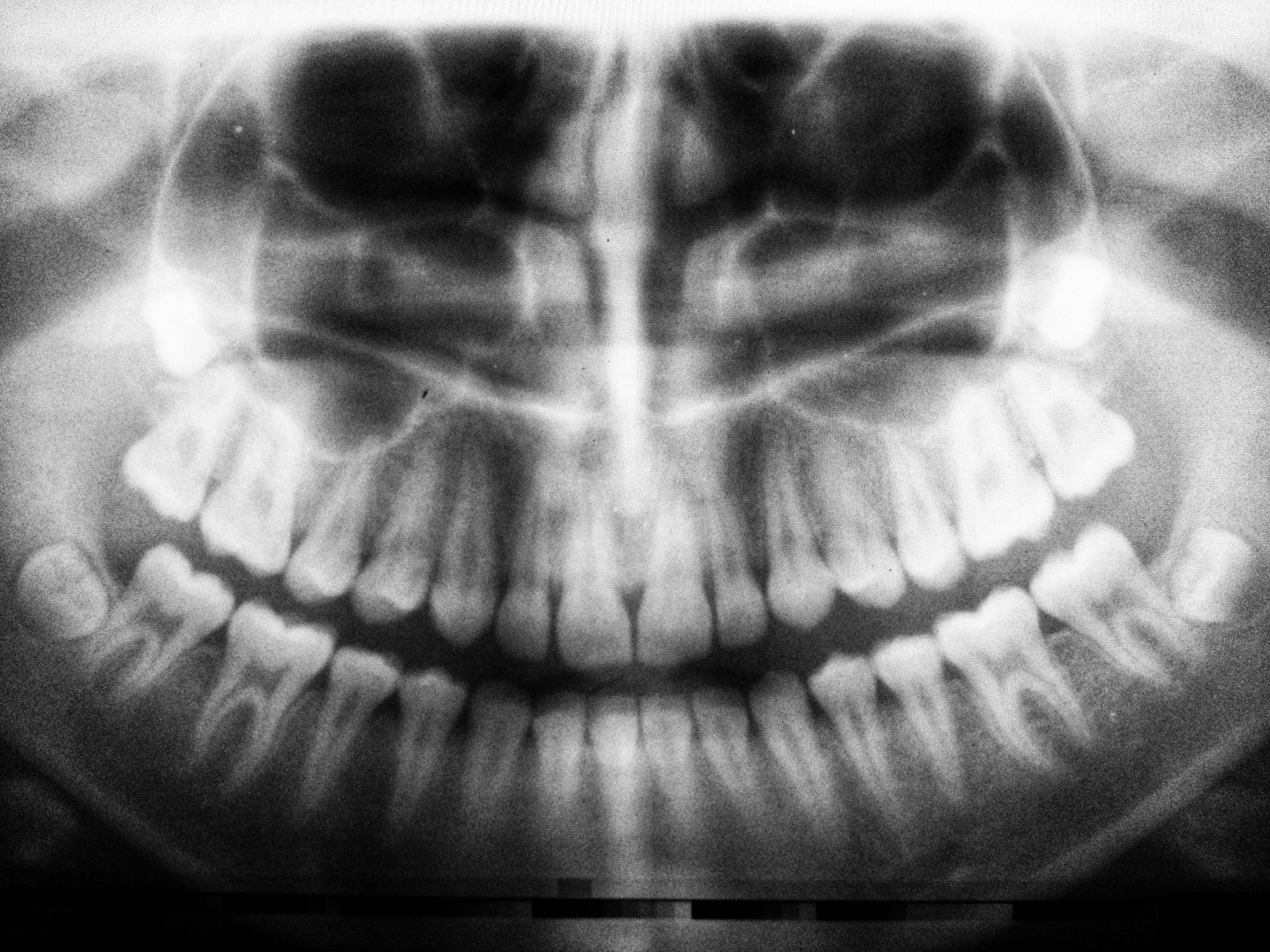 Pin hole surgery a new way of treating gum recession | Bupa