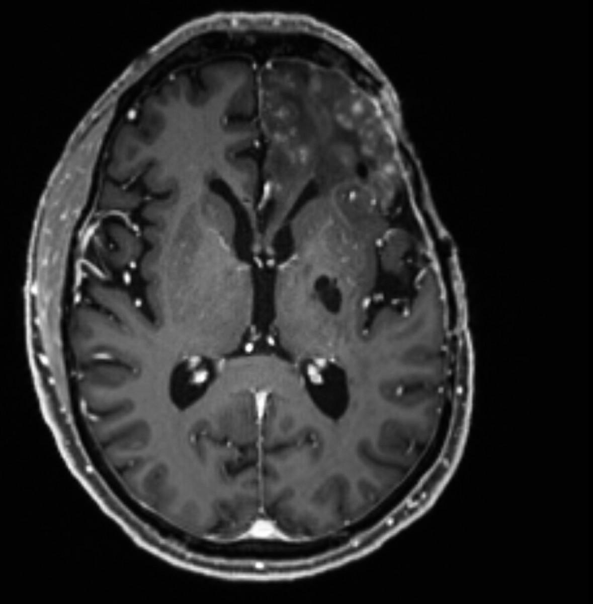 Path to Remission for a Brain Cancer That Is Usually Fatal