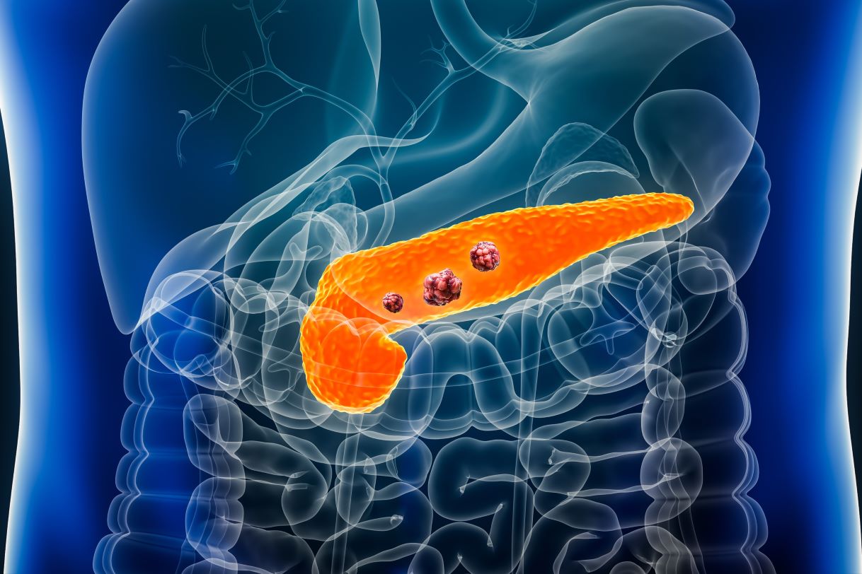 Study Reveals Potential Immunotherapy Advance for Pancreatic Cancer