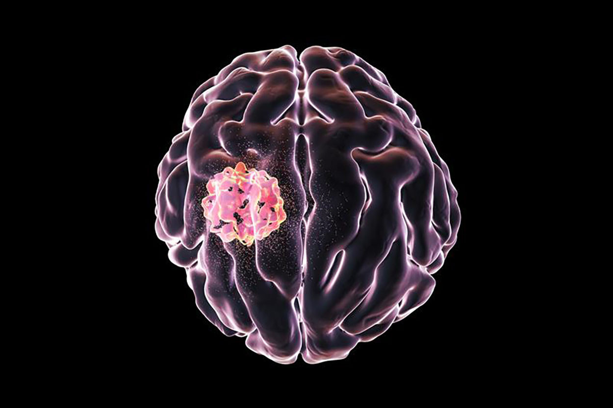 AI-Developed Brain Cancer Treatment Successful in Laboratory Mice