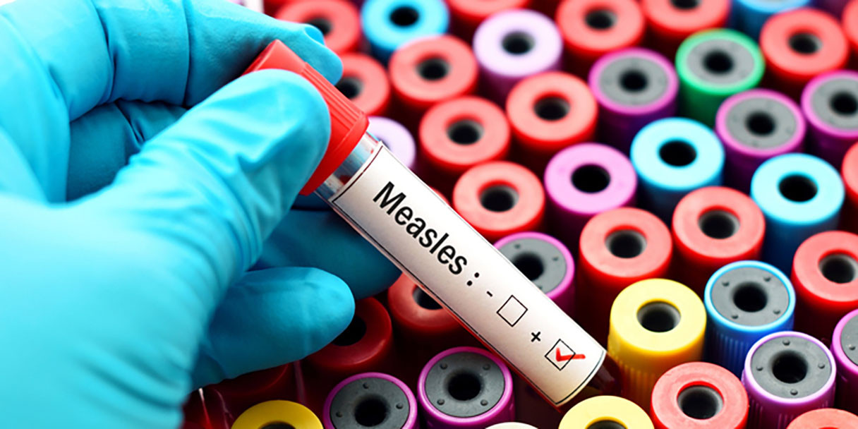 ABC 7: Measles Resurgence Sparks Concern as Outbreaks Spread Across US ...
