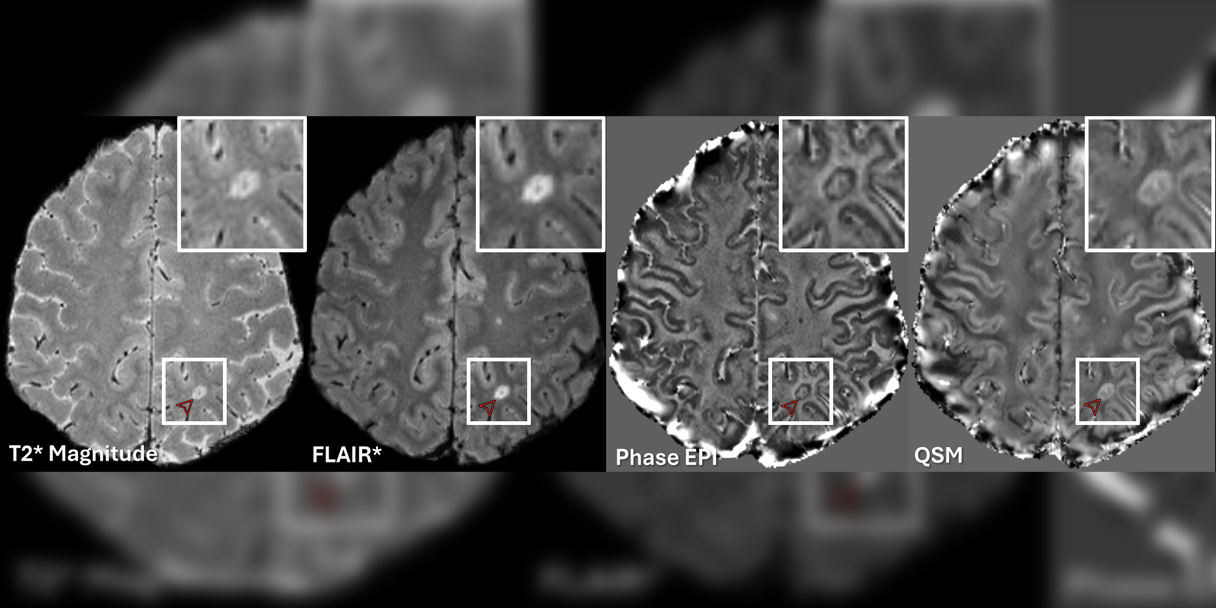The Latest About Multiple Sclerosis
