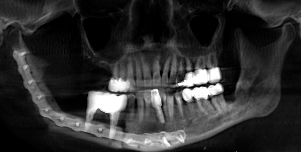 Rebuilding a Jaw in a Day