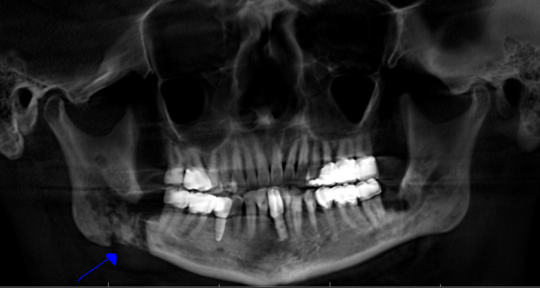 Rebuilding a Jaw in a Day