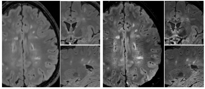 Neurology Live: The Future of Multiple Sclerosis Imaging