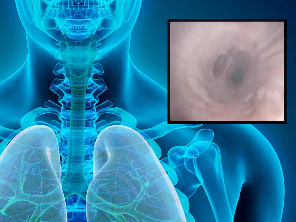 Pilot study shows even short-term ‘vaping’ causes inflammation in non ...