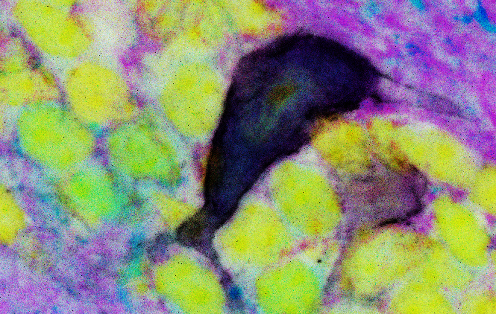 An unexpected link between 2 schizophrenia risk proteins