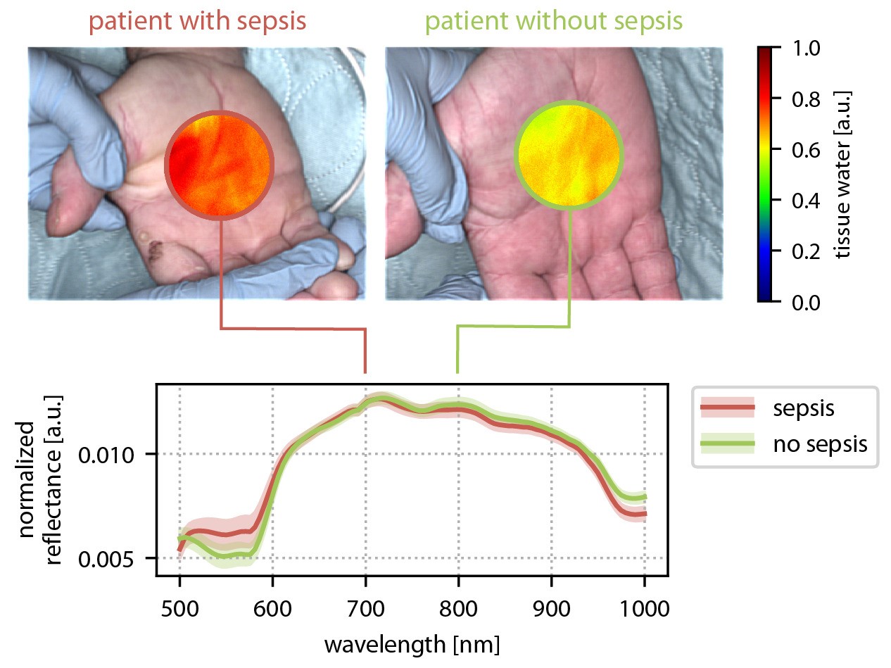 Faster sepsis diagnosis through hyperspectral imaging and AI