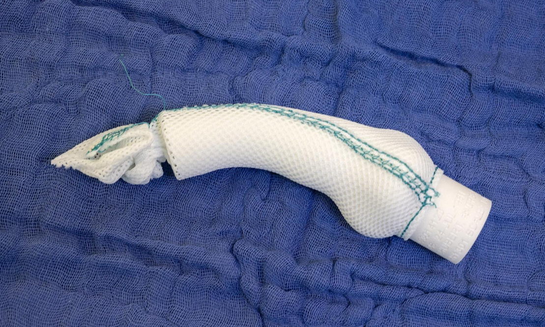 Wenn die Aorta zu reißen droht: Stützen statt ersetzen