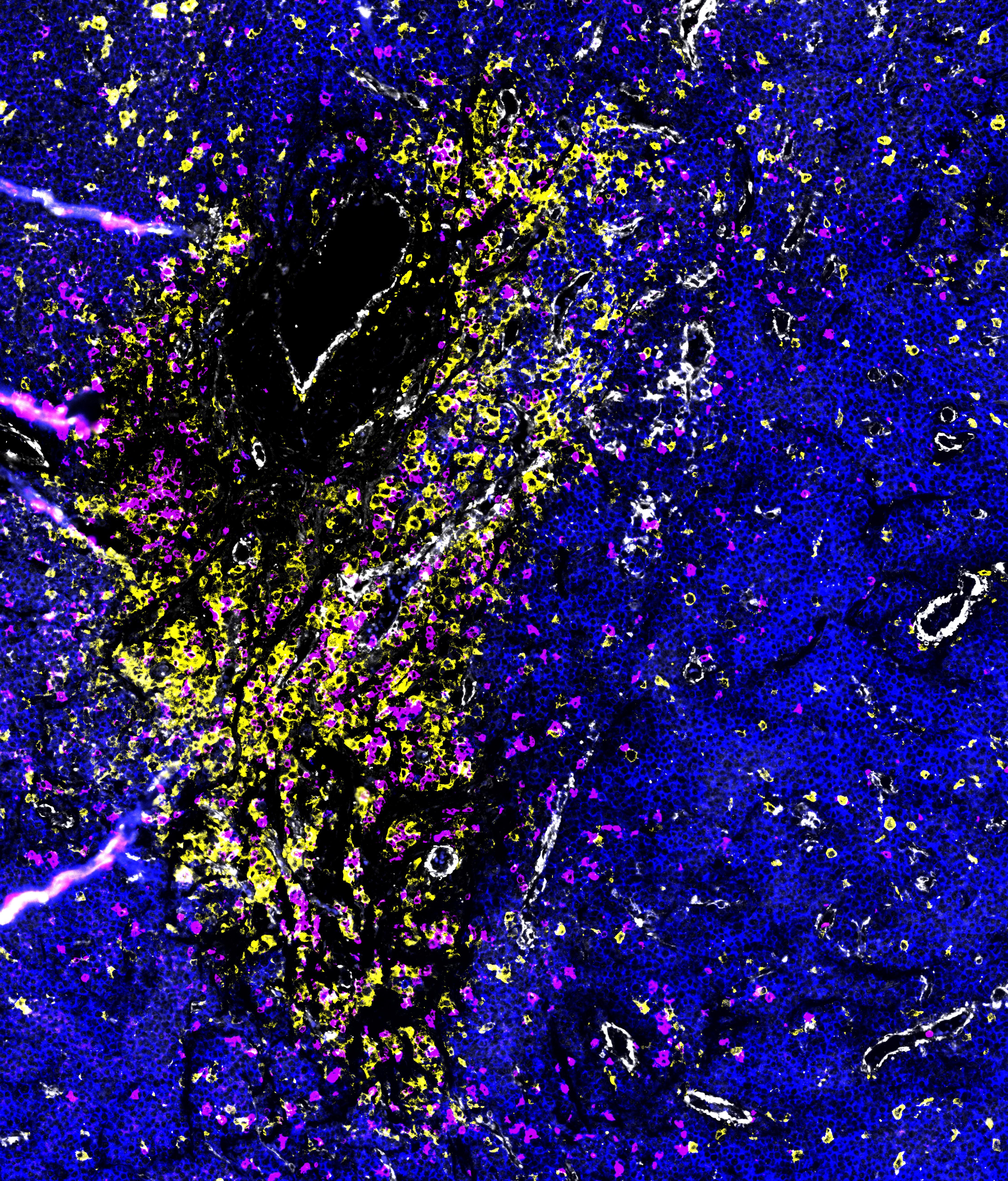 Multiples Myelom: Brechen Krebszellen aus dem Knochenmark aus, entsteht ...