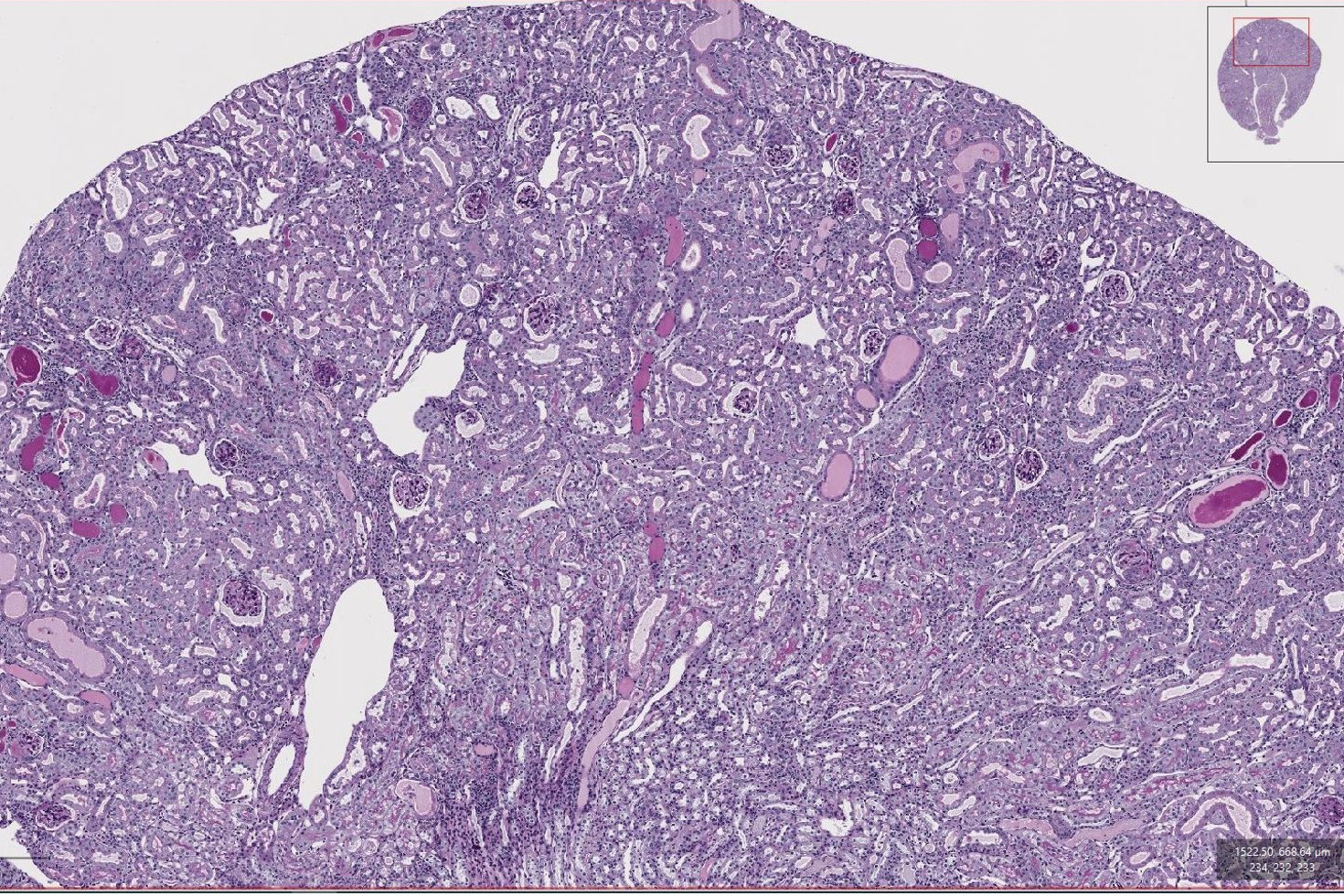 ERC Funding for promising therapy for kidney disease
