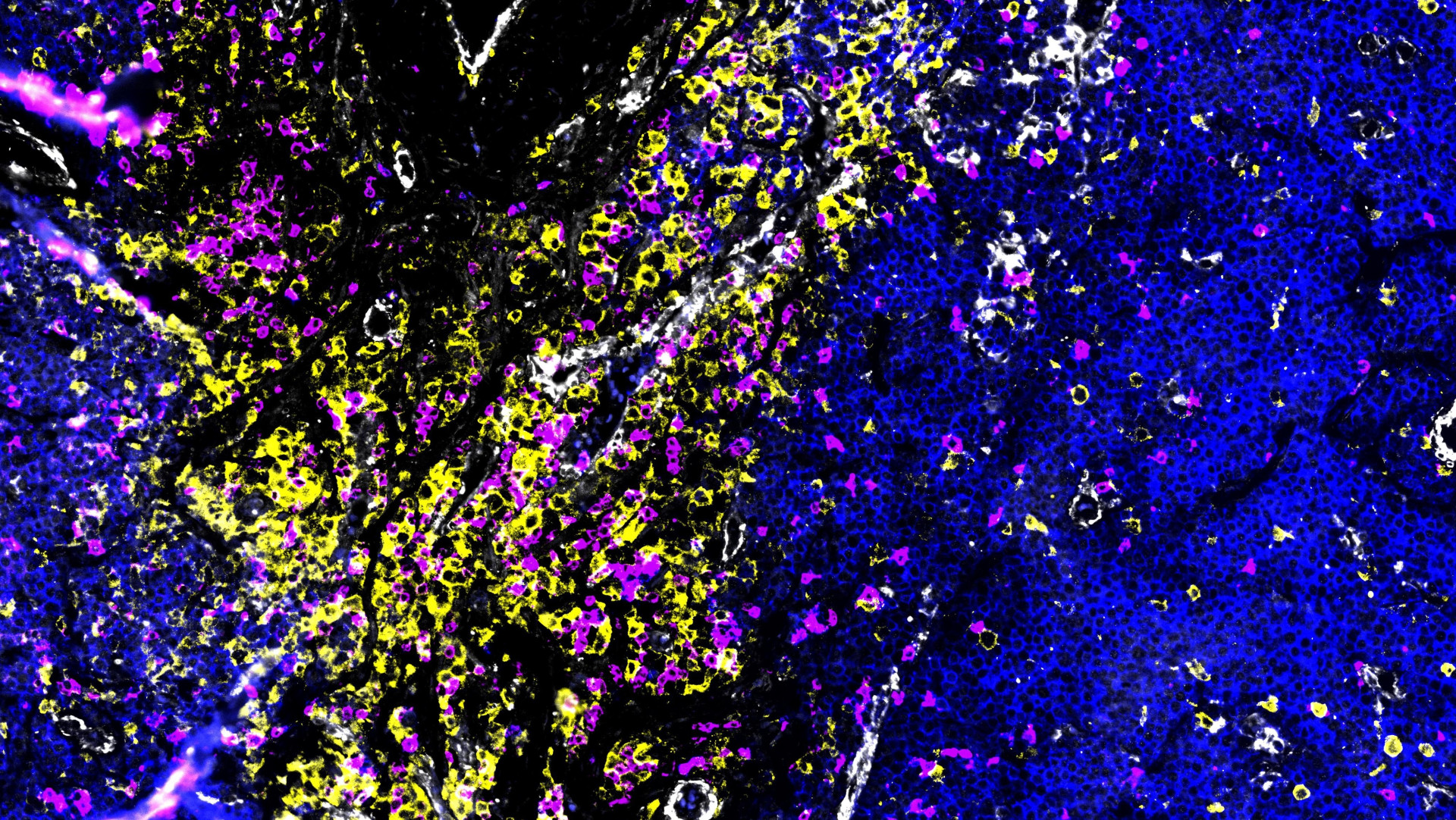 Multiples Myelom: Brechen Krebszellen aus dem Knochenmark aus, entsteht ...