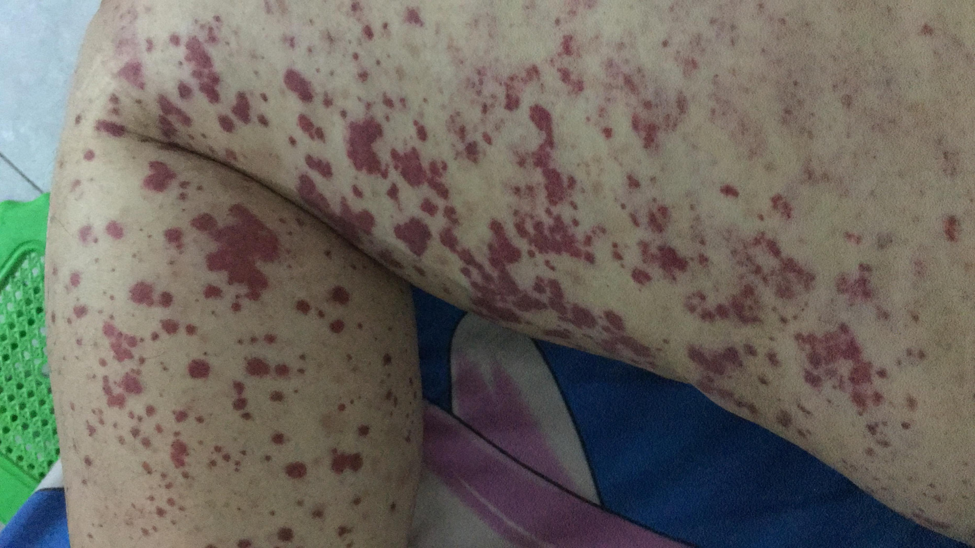 Study Shows Avacopan Effective for Most Serious Vasculitis Cases
