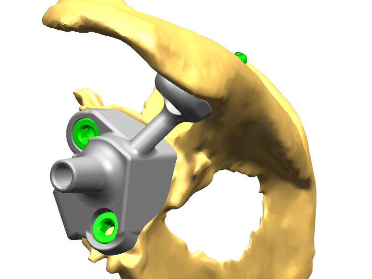 First Surgeries Completed With Patient-Specific 3D Printed Implants ...