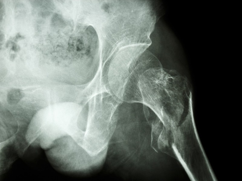 Use of Nerve Blocks for Hip Fracture Surgical Patients is Increasing ...