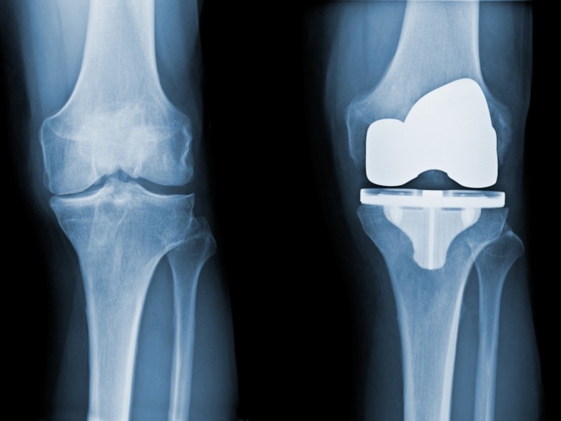 Addition of Periarticular Injection to Adductor Canal and IPACK Blocks ...