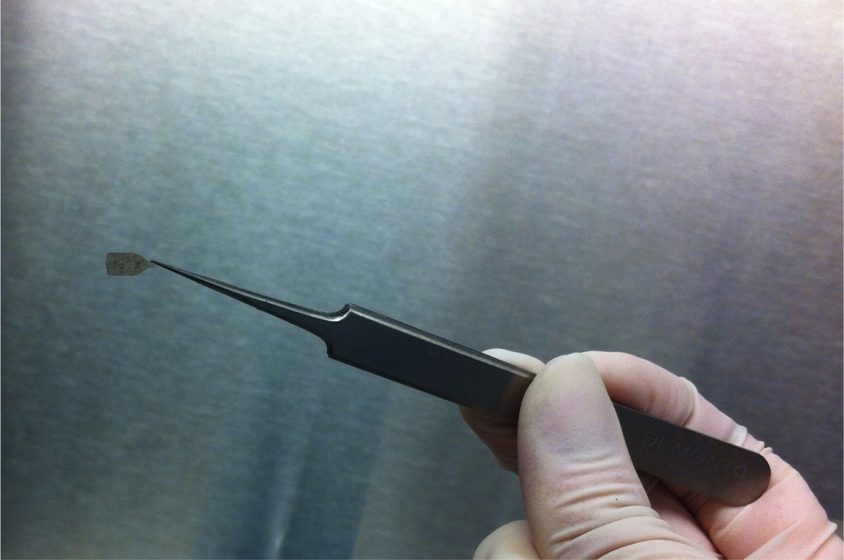 Can a retinal implant reverse macular degeneration?