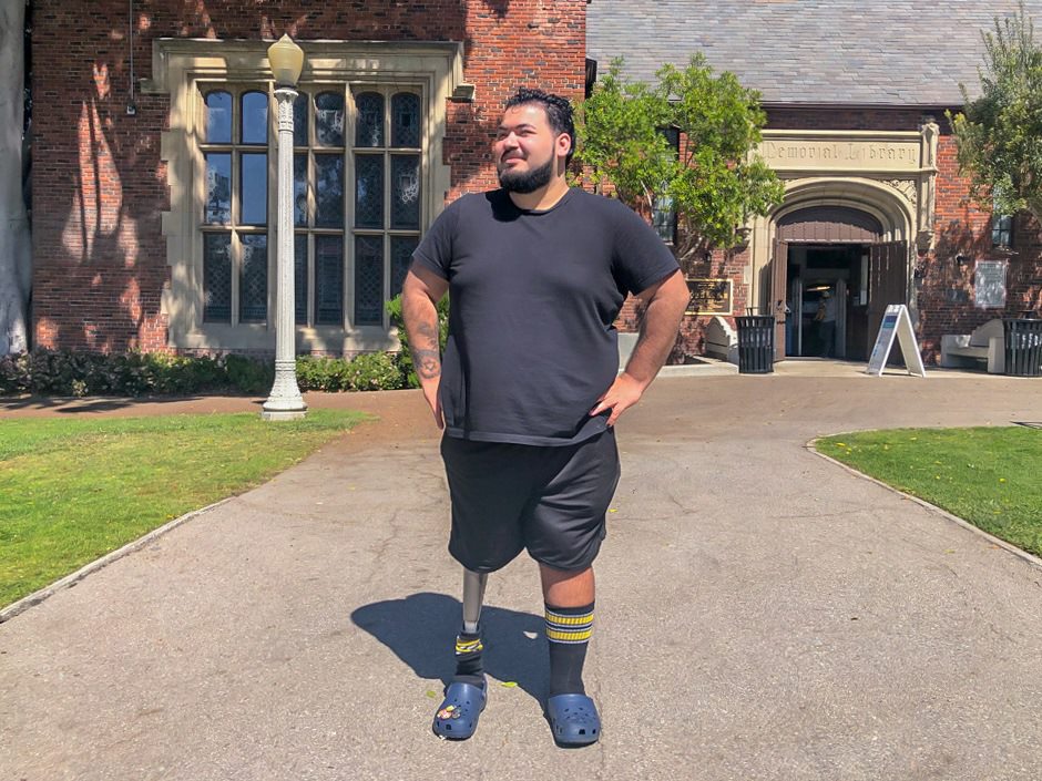 Young man with prosthetic leg finds new hope through innovative new surgery