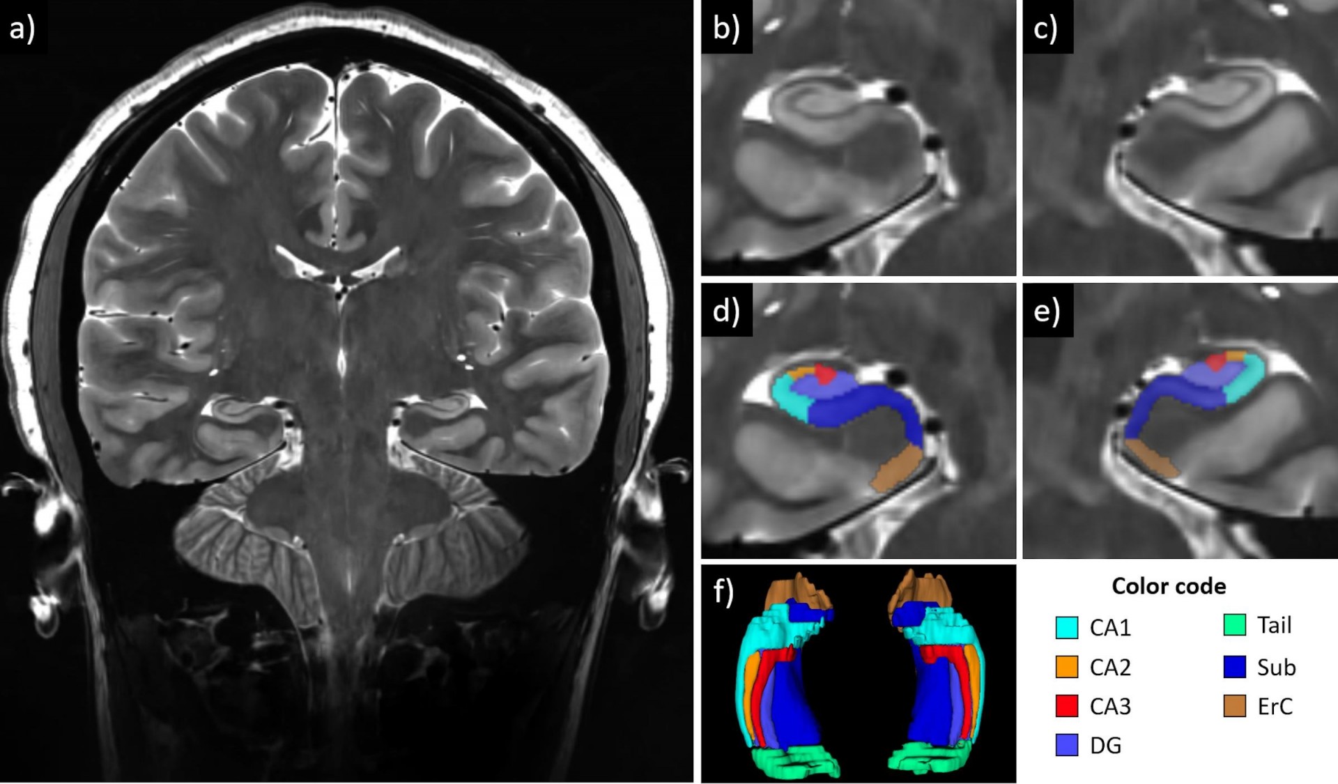 Using Advanced Imaging to Study Sickle Cell Disease