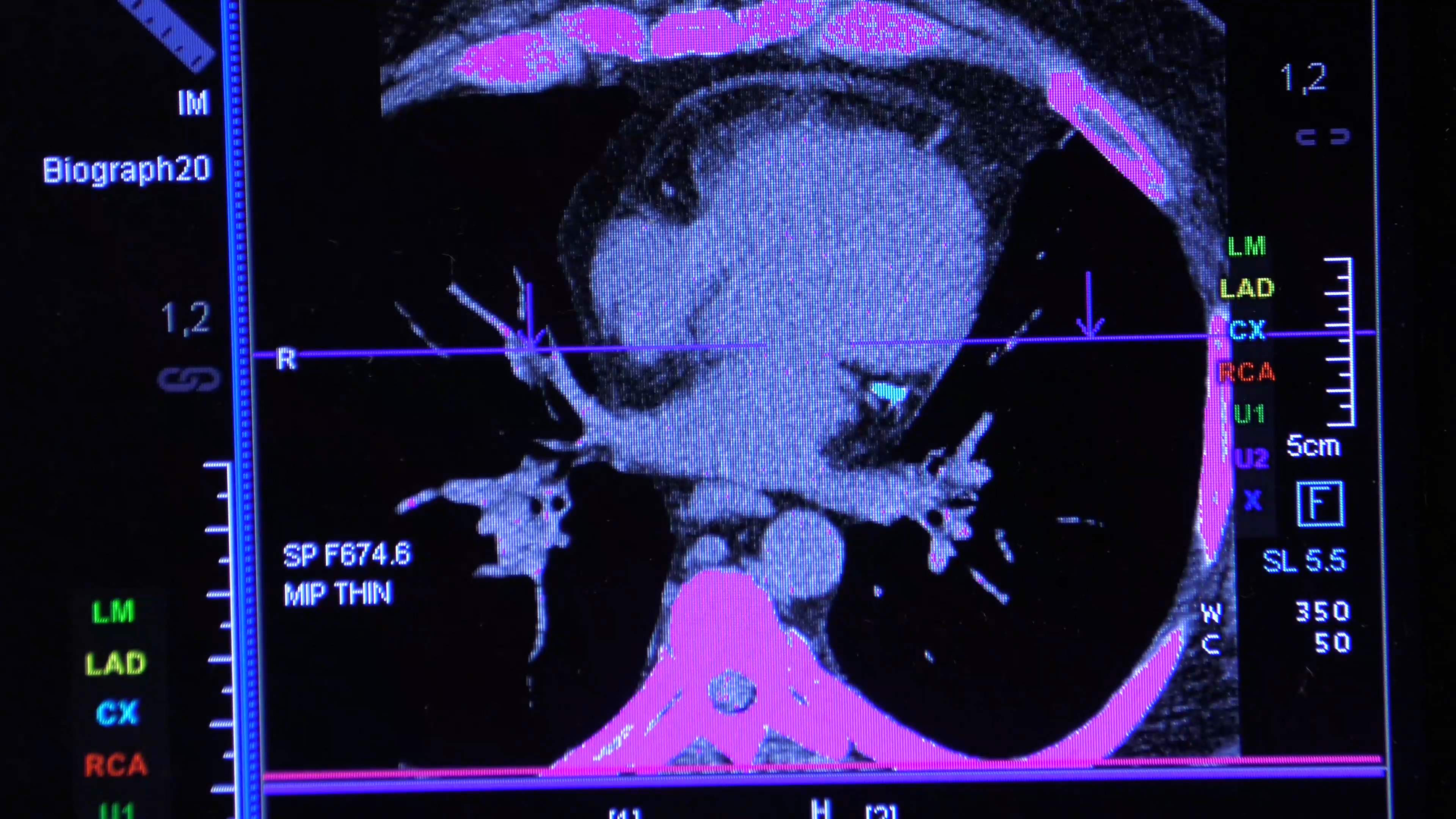 Low Coronary Artery Calcium Score is Associated with An Excellent ...