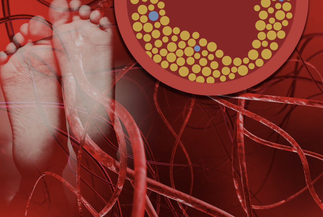 Occlusive Disease Coronary Artery Disease | Conditions & Treatments