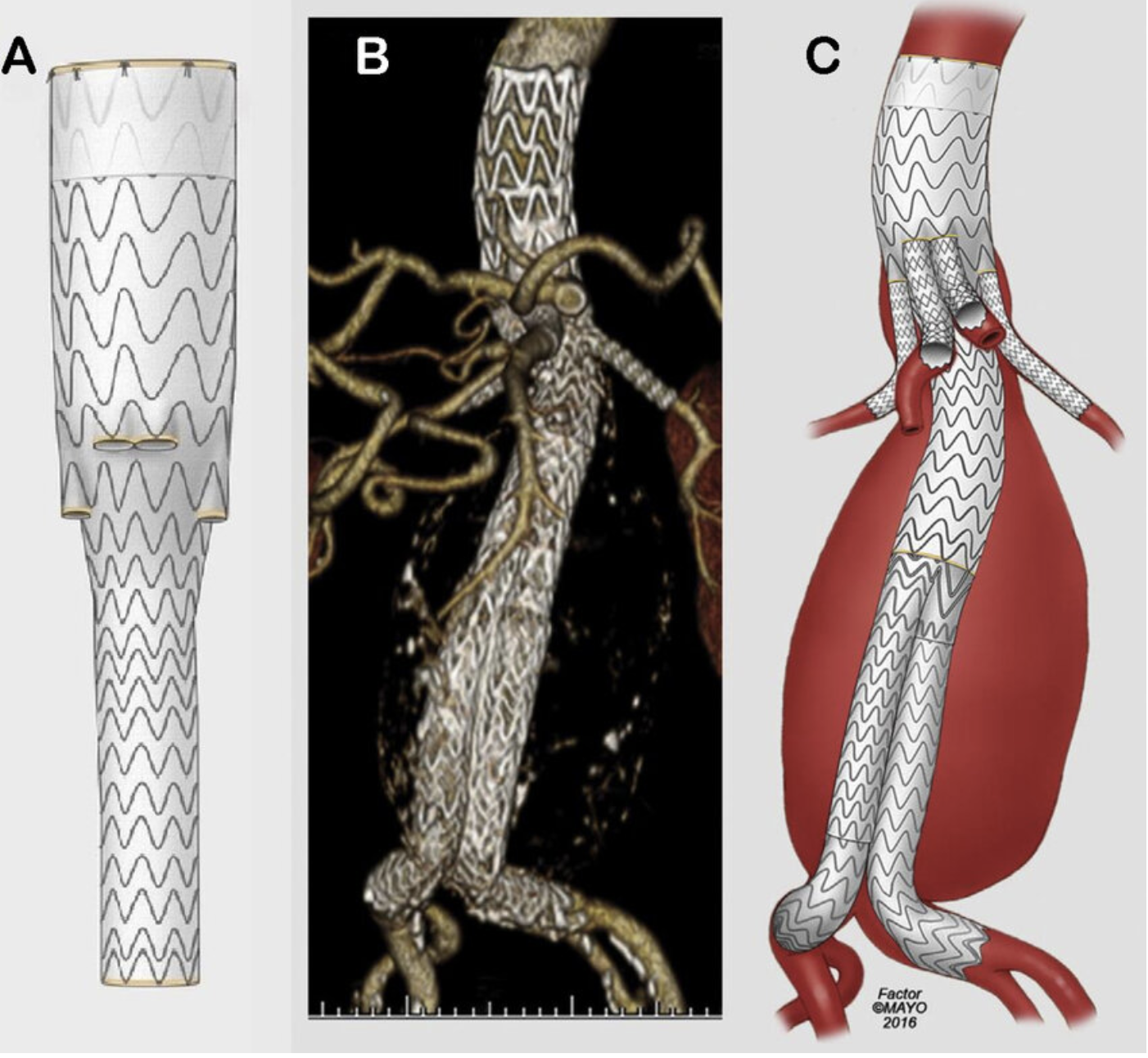 Intermountain Medical Center First in Nation to Use FDA-Approved Device ...