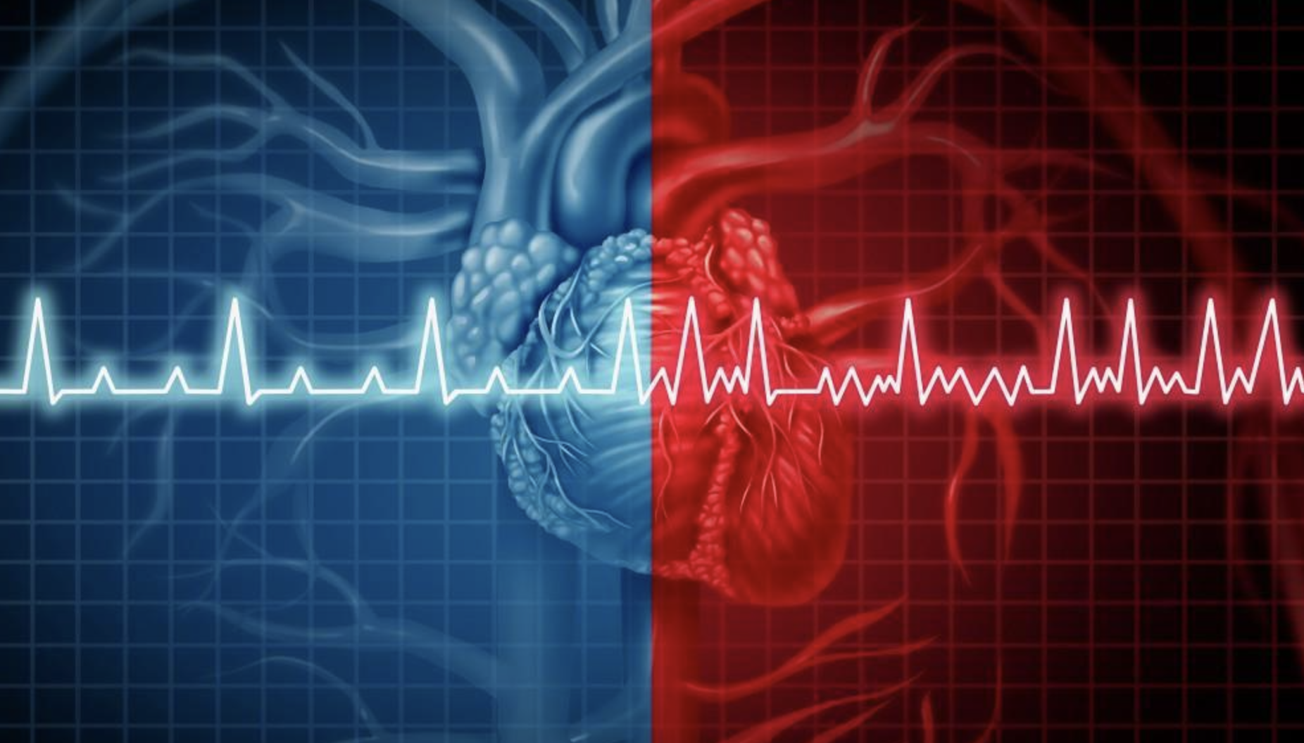 Intermountain Study Finds Atrial Fibrillation Common in Newly Diagnosed ...