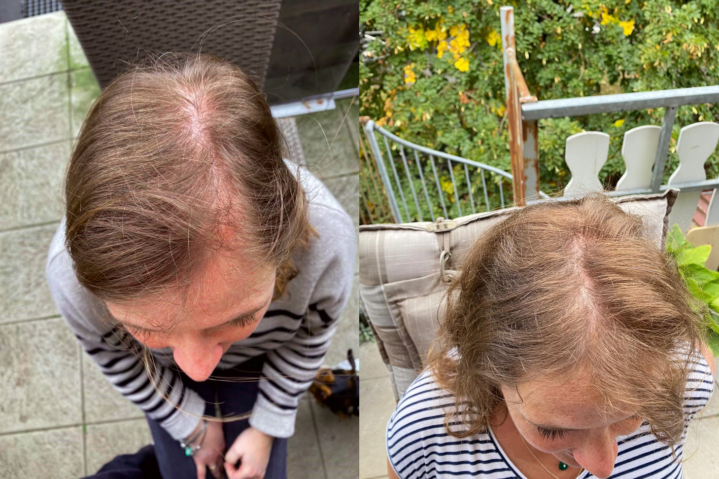 Erblich bedingter Haarausfall: Erfahrung trifft auf Forschung