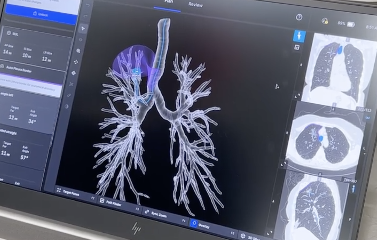 Advancing Lung Cancer Diagnosis With Robotics