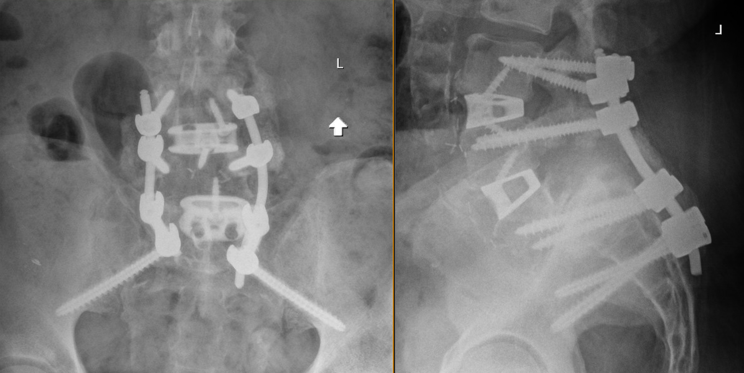 After years of severe back pain, Chicago resident returns to activities ...