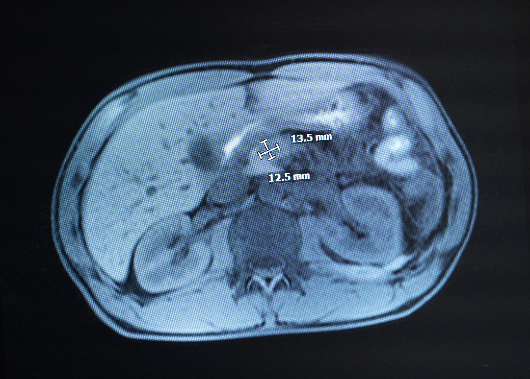 Northwestern Medicine team correctly diagnoses man with rare pancreatic ...