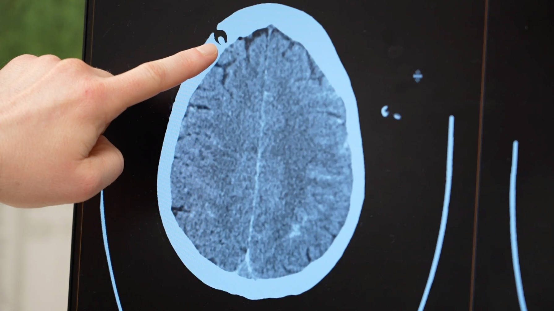 Northwestern Medicine first to use bedside neurosurgical drill that ...